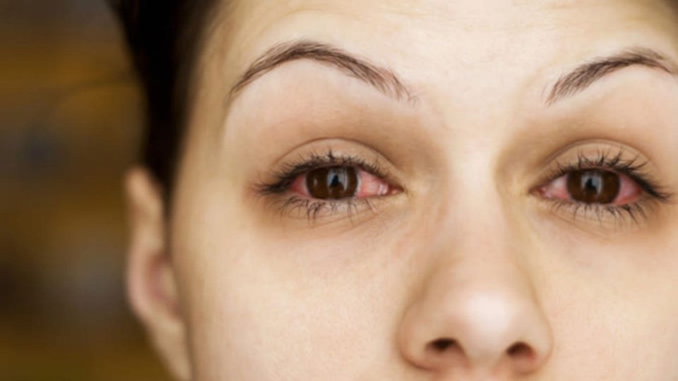 Is Eye Flu Dangerous? Exploring The Symptoms, Reasons, And The Treatment